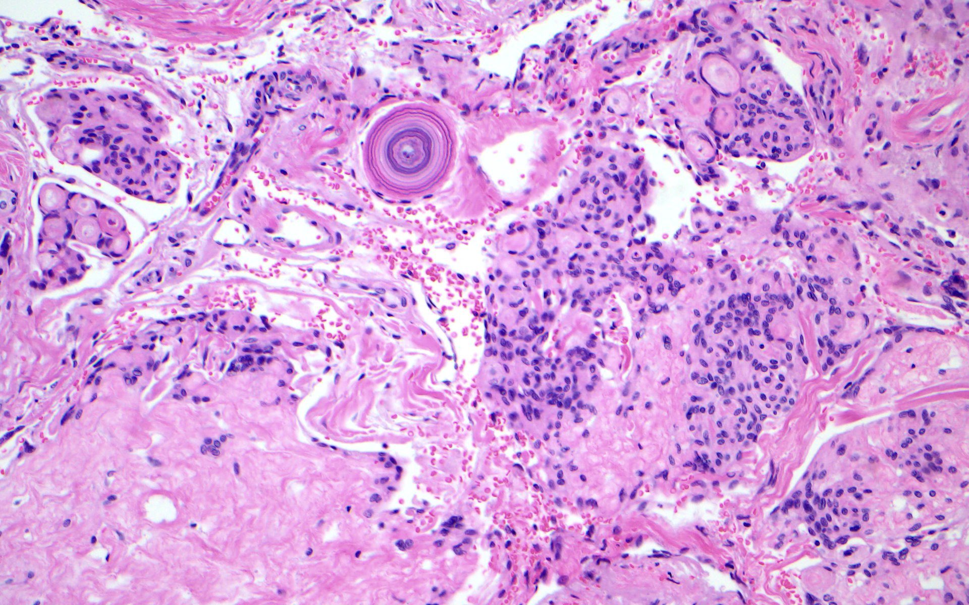 Arachnoid Granulations