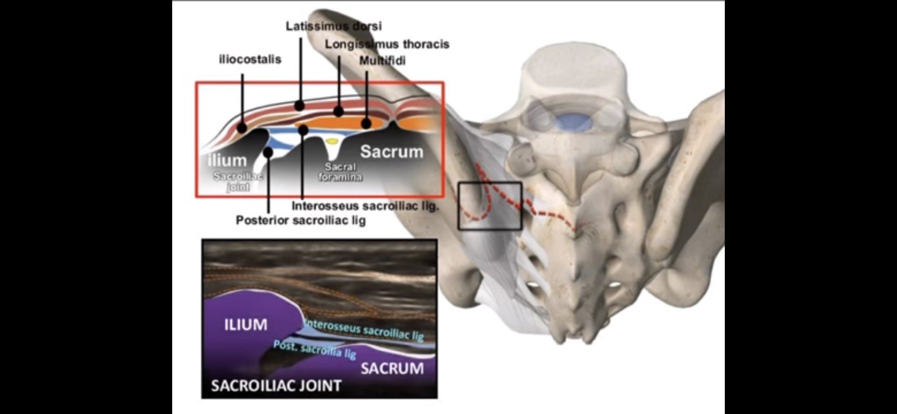 Sacroiliac Joint Injection Technique