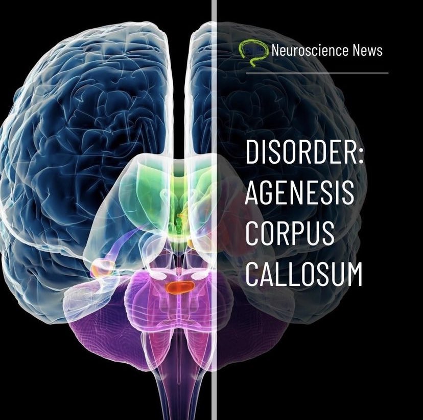 Complete Agenesis Of Corpus Callosum