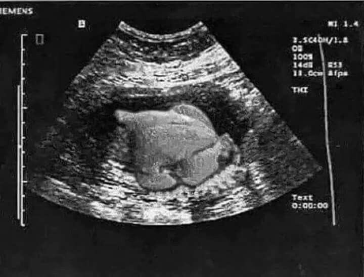 Funny Ultrasound Meme