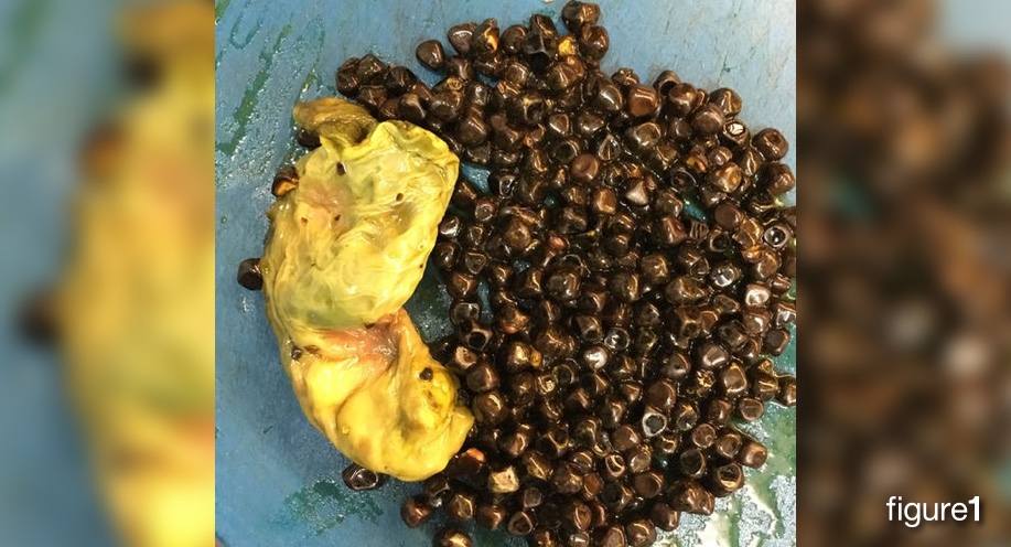 Gallstones In Poop