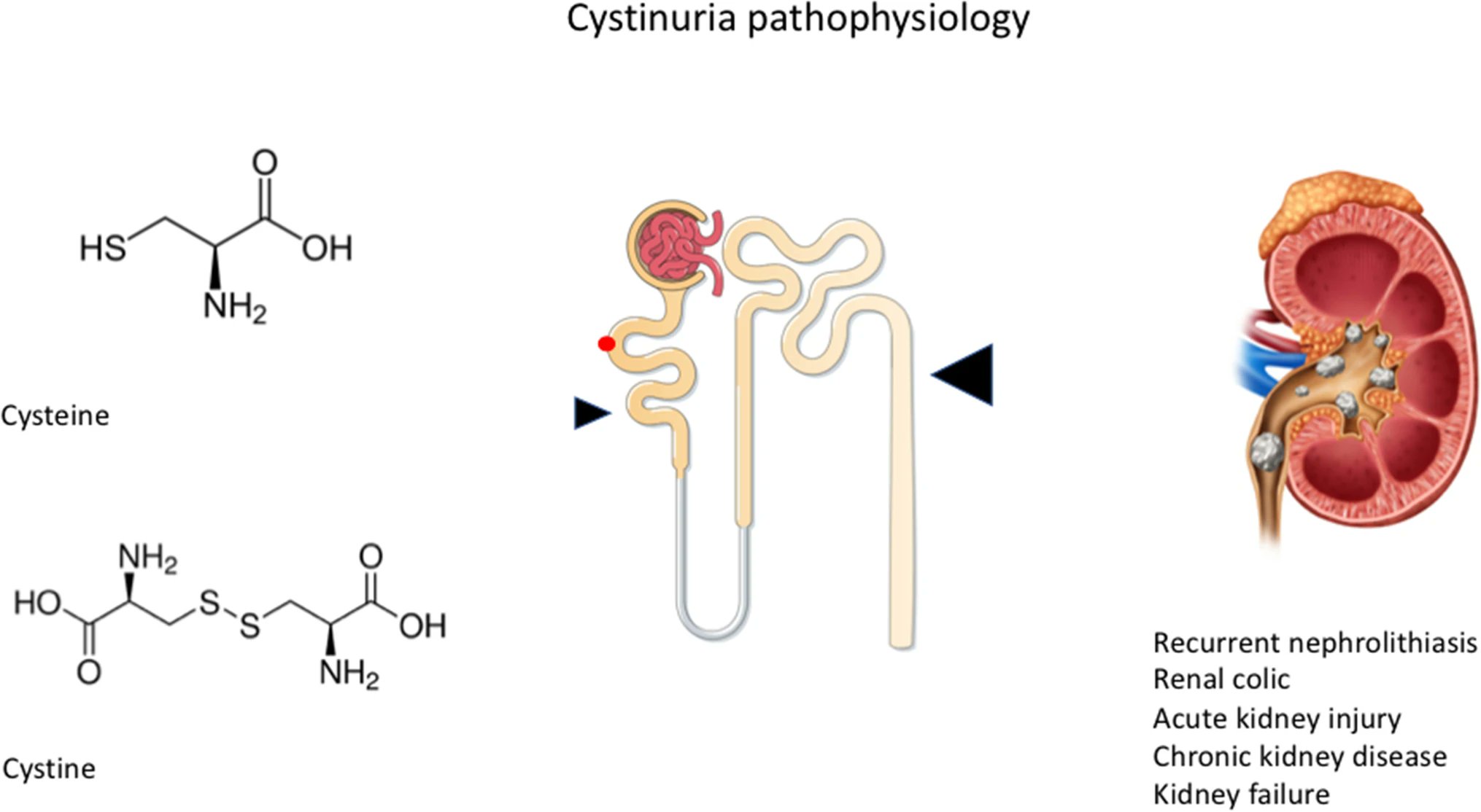 Nephrolithiasis Pathophysiology Diagram