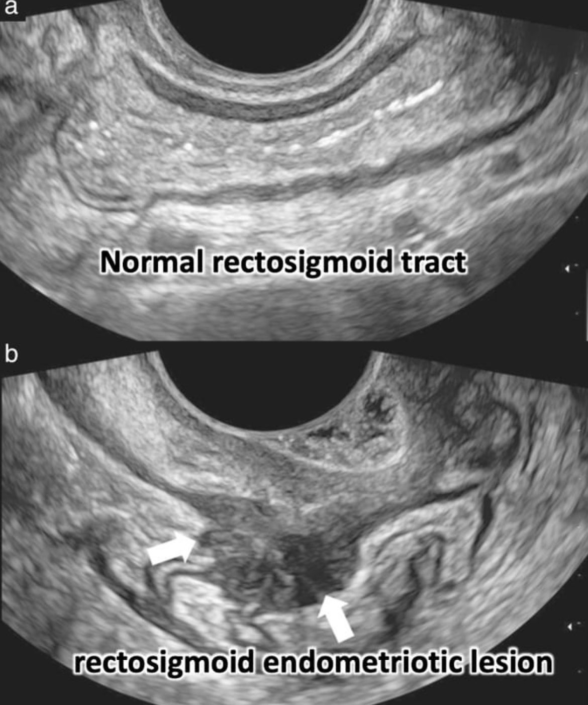 Endometritis Ultrasound
