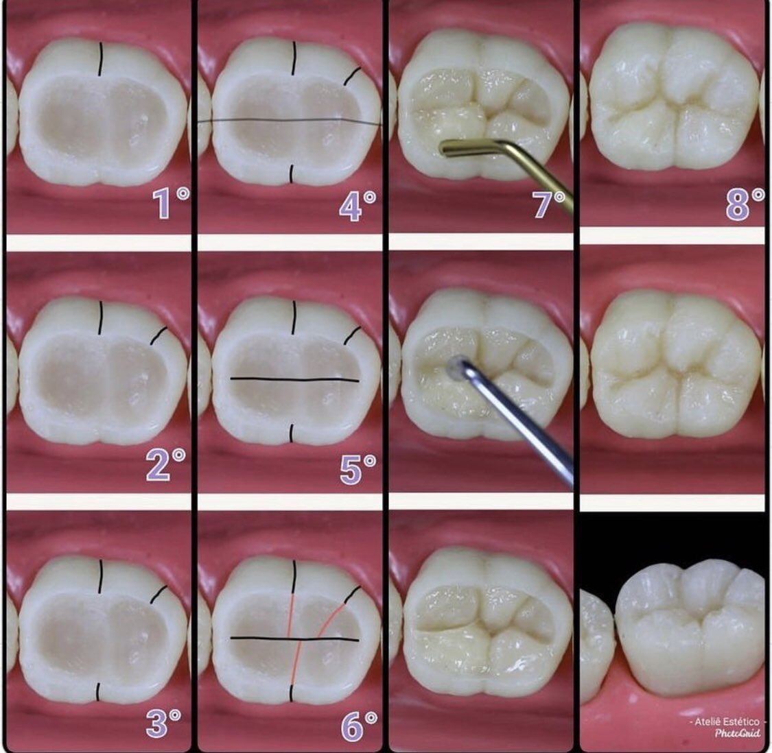 Lower Molar Occlusal Anatomy Occlusal Anatomy Of Maxillary First Molar