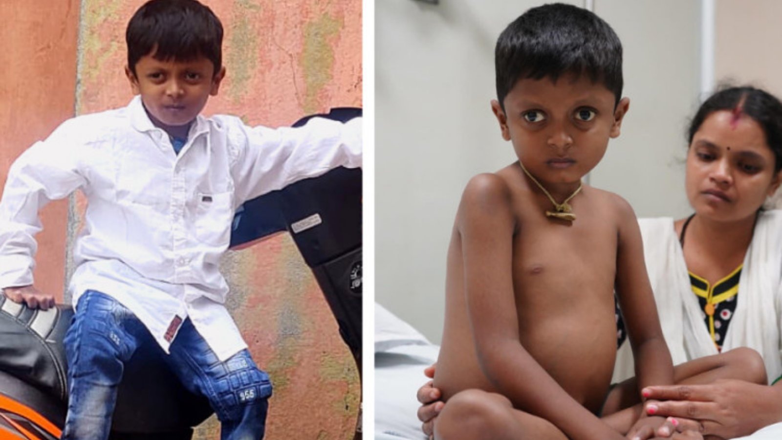 People With Extra Limbs