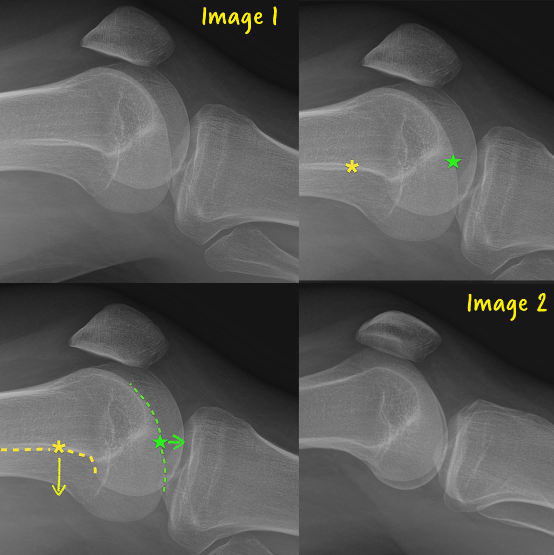 Lateral Knee X Rays
