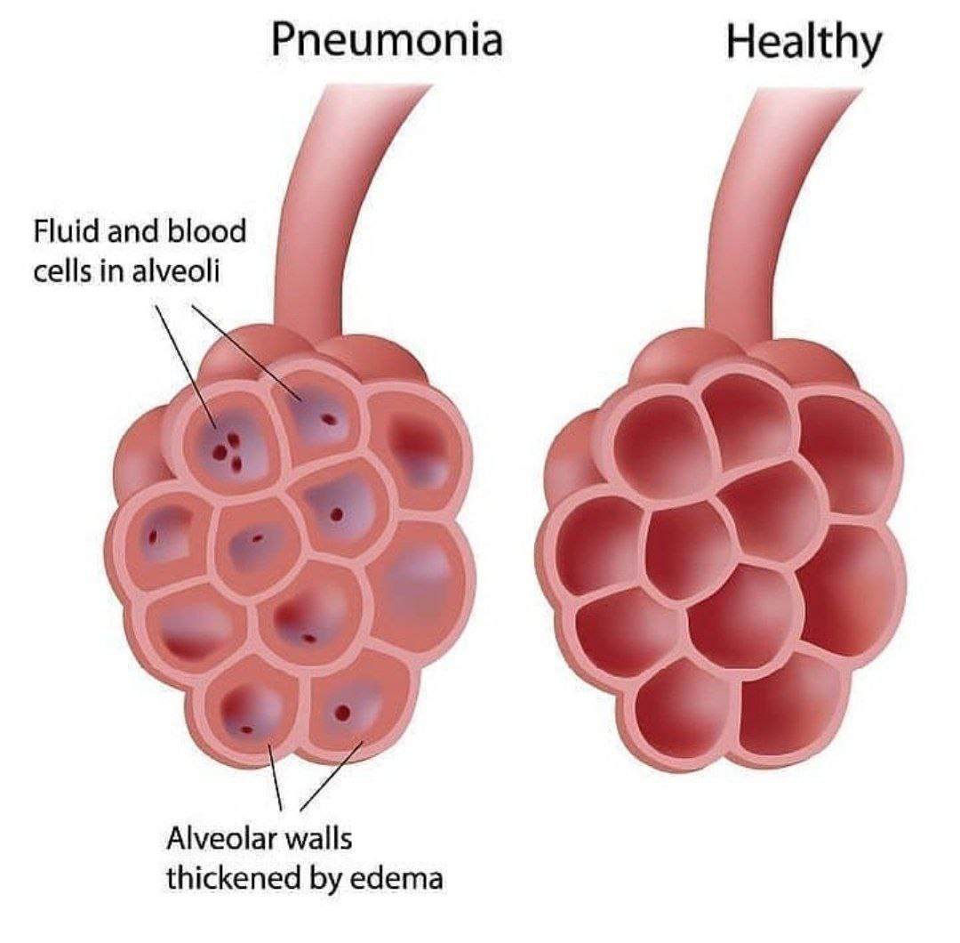 Pneumonia Sputum