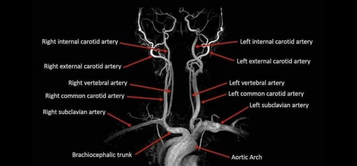 Circle Of Willis Mri Labeled