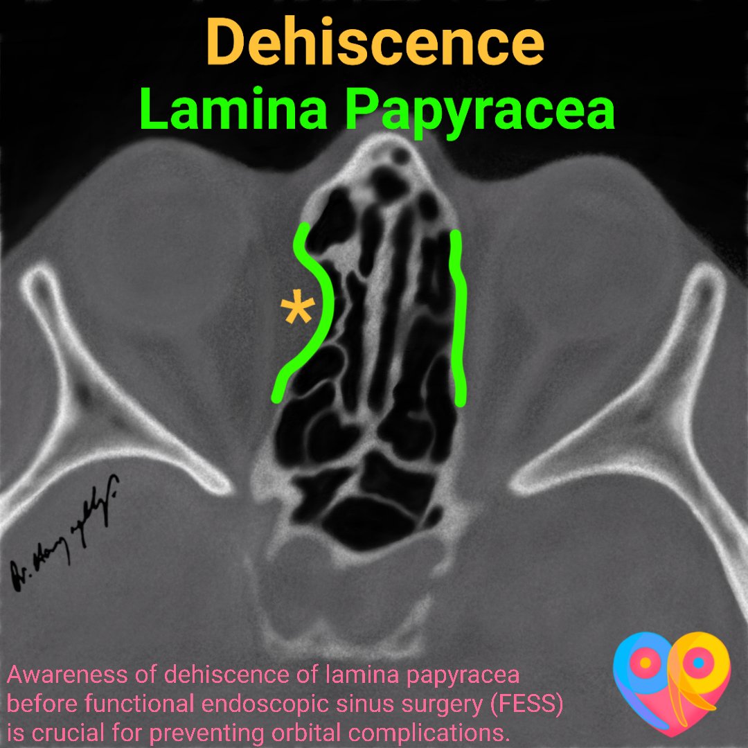 Lamina Papyracea Fracture Update On Orbital Anatomy | Eye