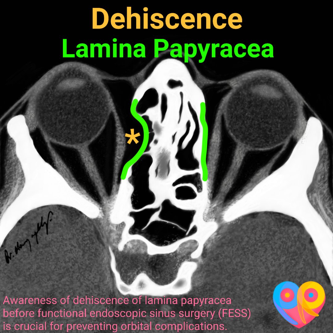 Lamina Papyracea Fracture Update On Orbital Anatomy | Eye