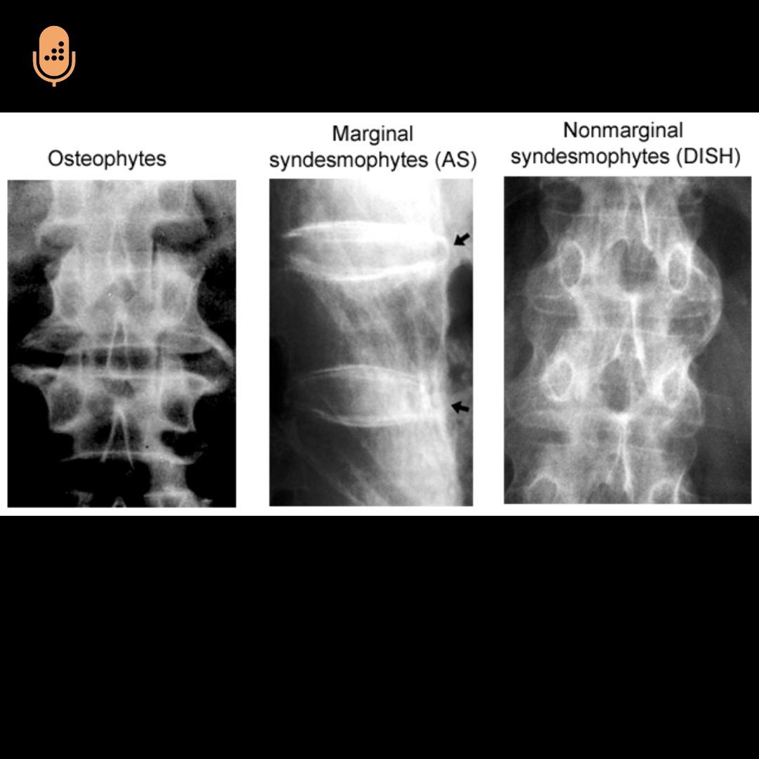 Syndesmophytes Ankylosing Spondylitis