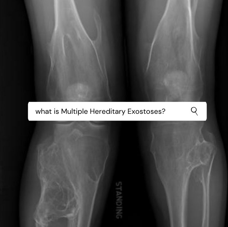 Multiple Hereditary Exostoses (mhe)