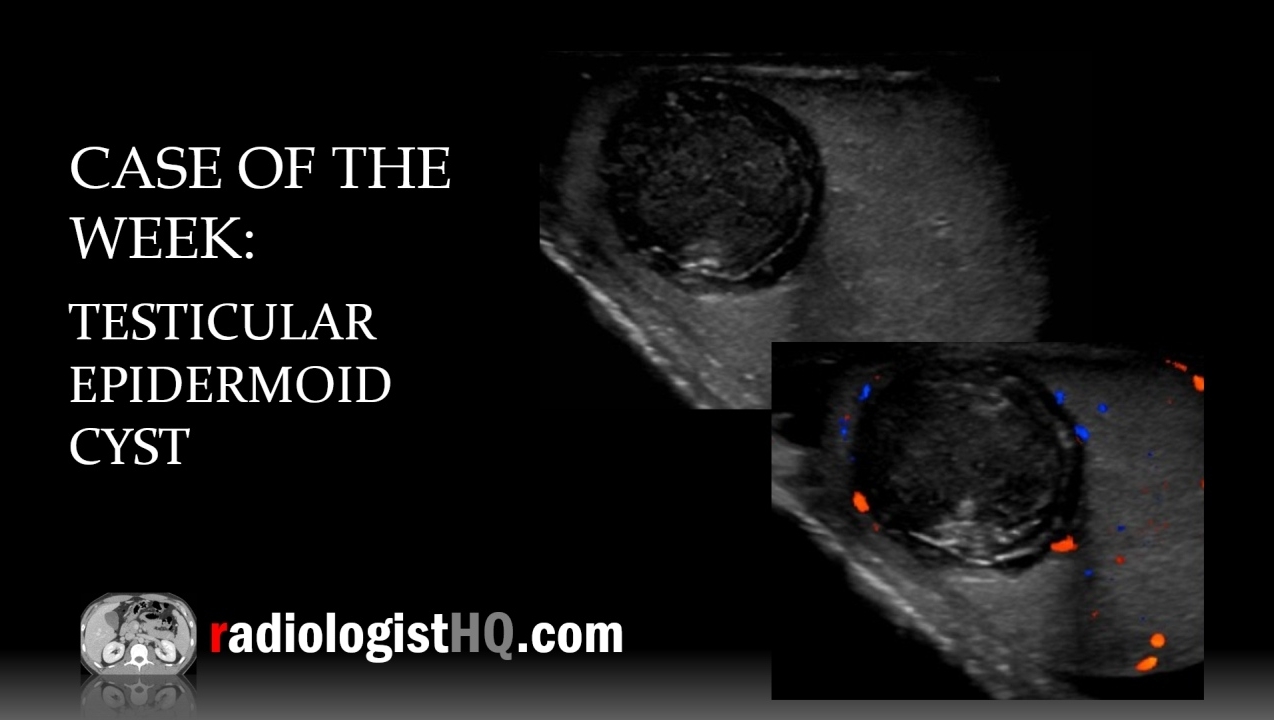 Testicular Cyst Ultrasound