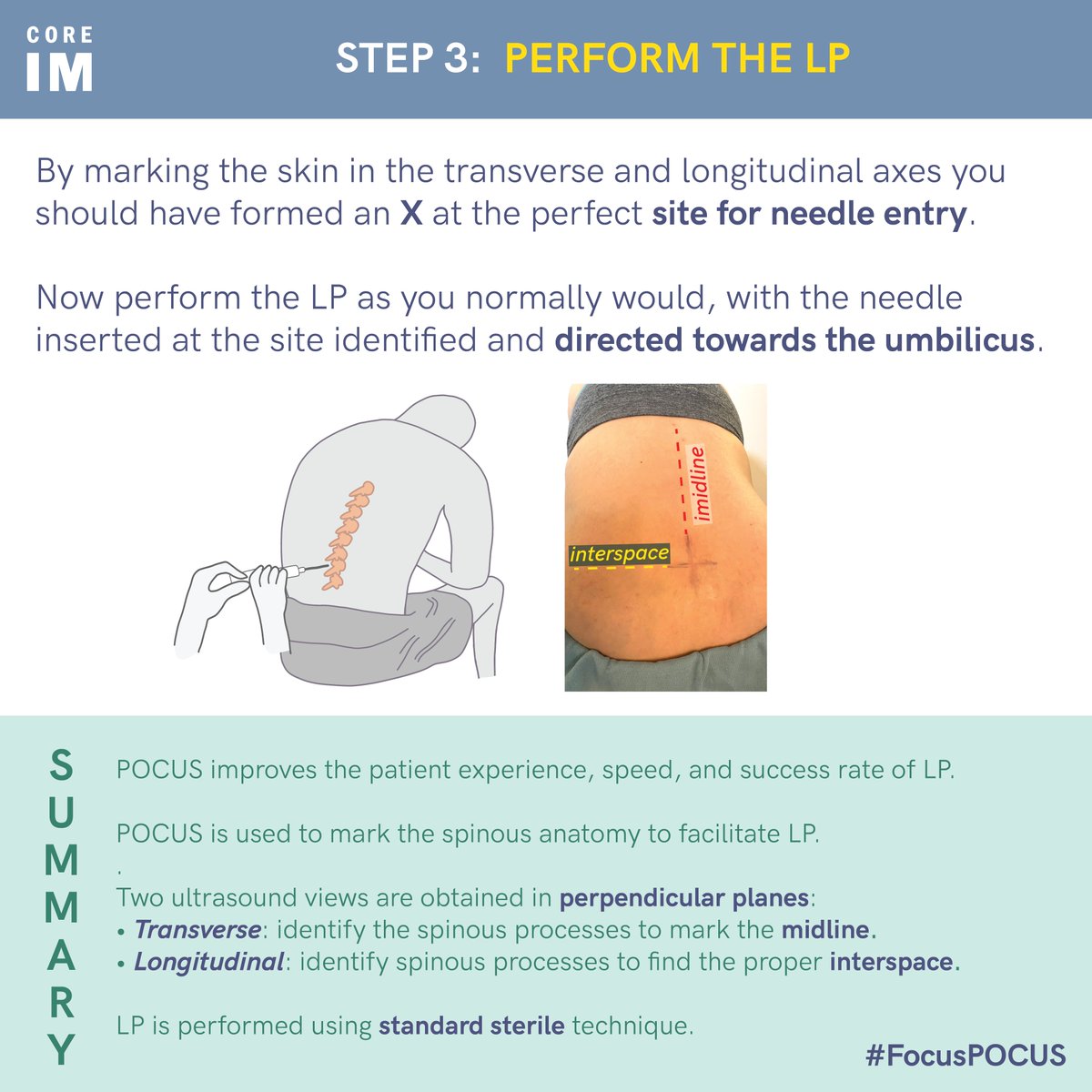 1/ Welcome back #MedTwitter to Part 2 of #FocusPOCUS Guided LPs. Last ...