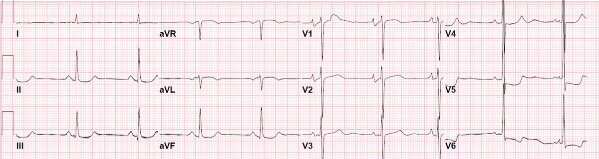 Interesting ICU case! 74 female recently discharged 1 week ago ...