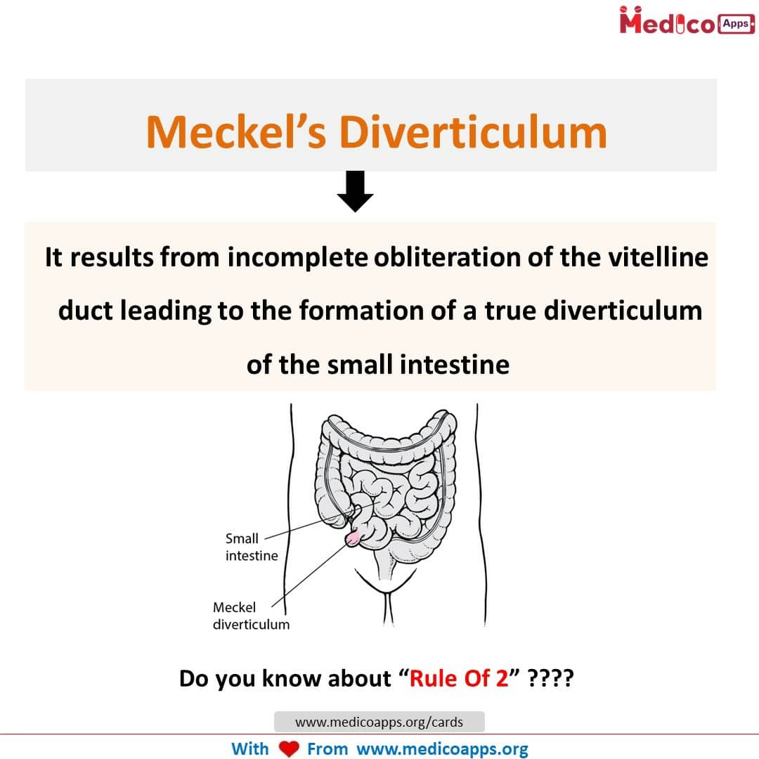 Meckel Diverticulum
