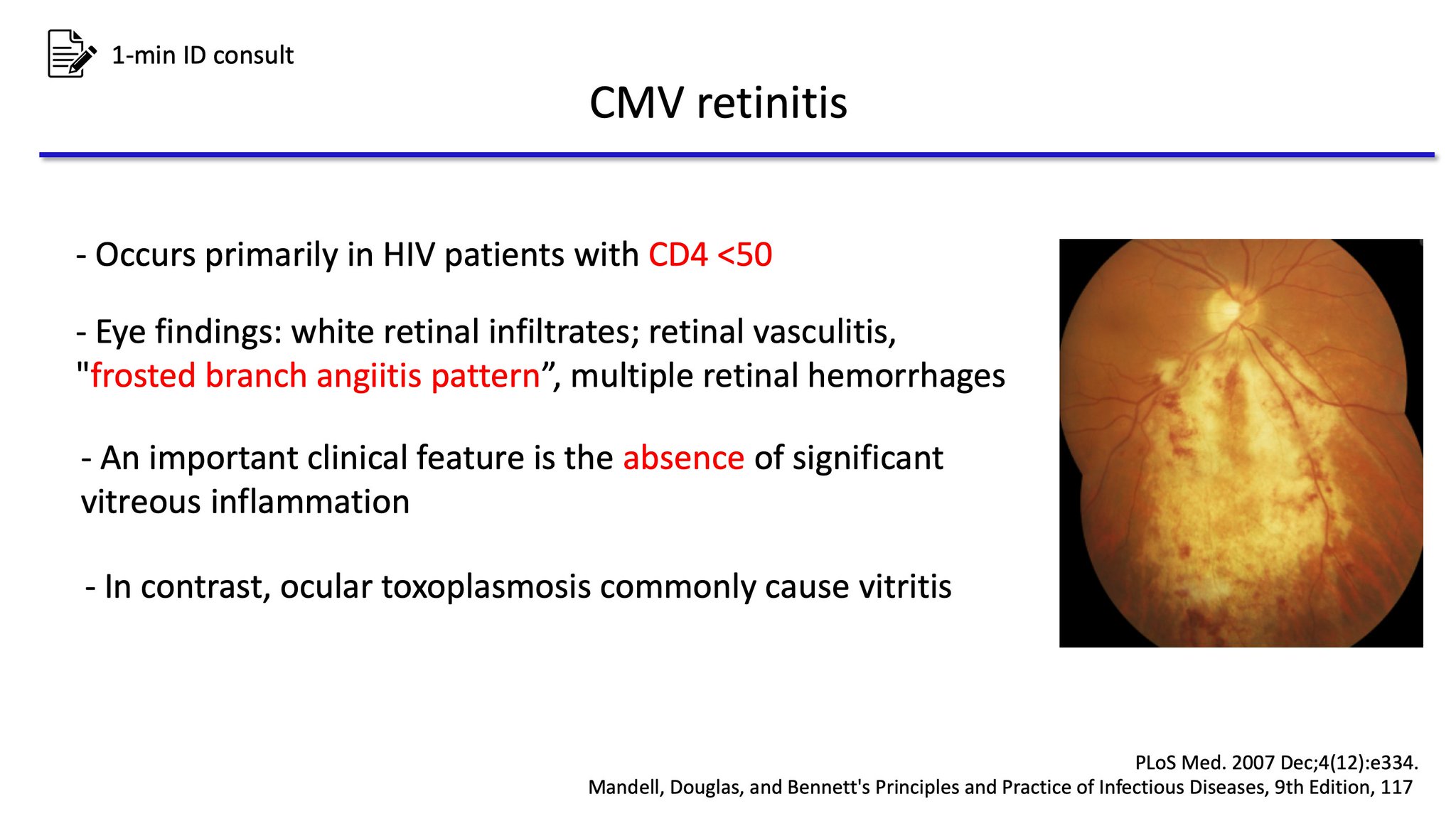 Cmv Retinitis Hiv