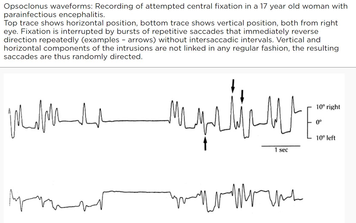 1/ Opsoclonus myoclonus syndrome (OMS) – also known as “dancing eyes ...