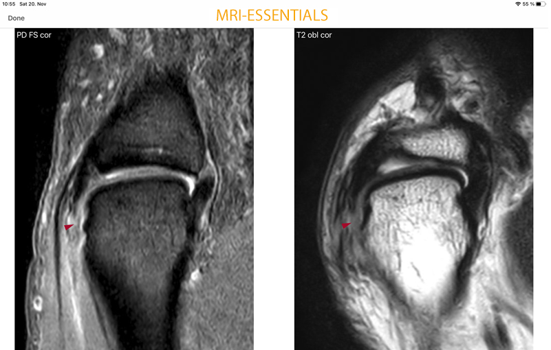 Ulnar Collateral Ligament Thumb Mri