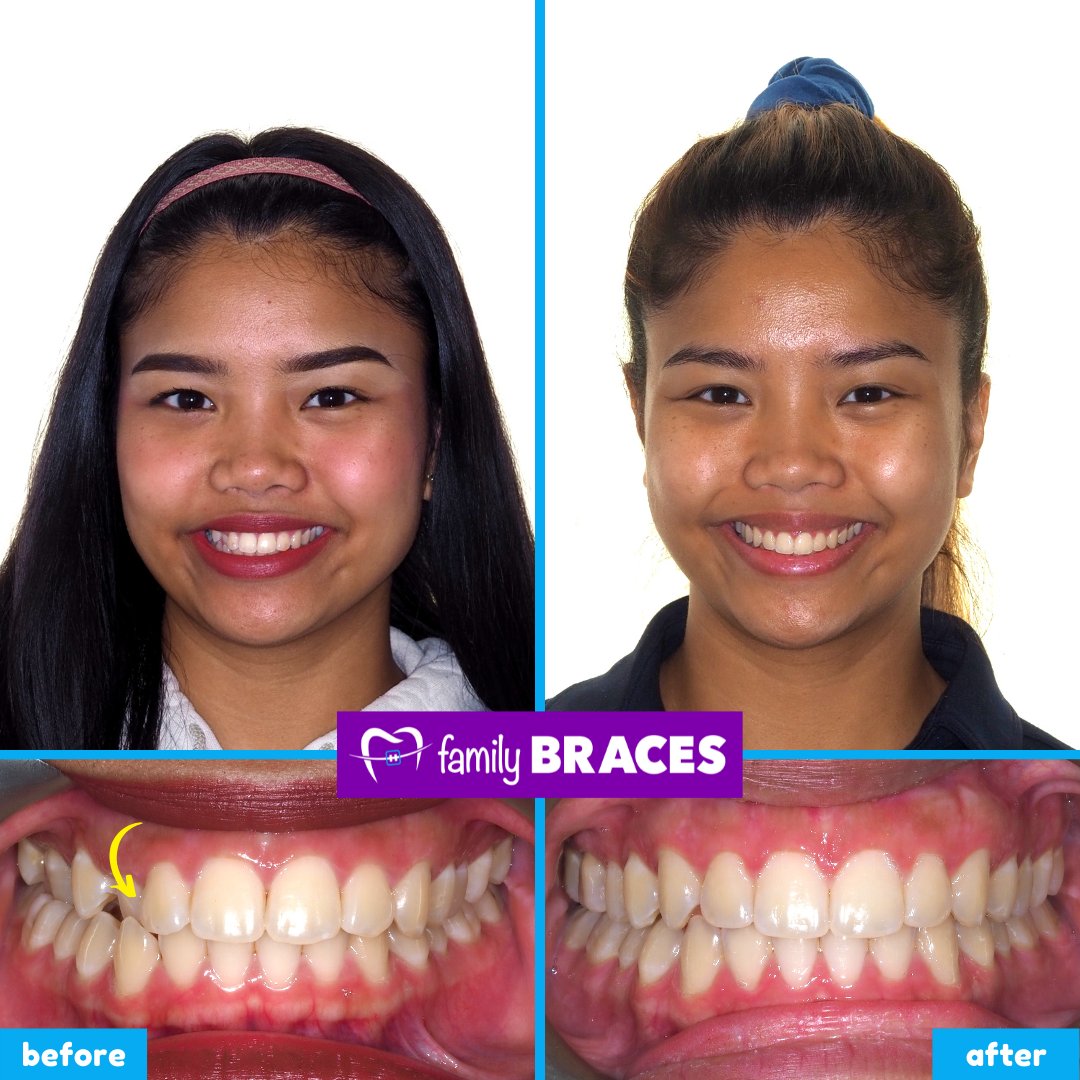 Invisalign Before And After Crossbite