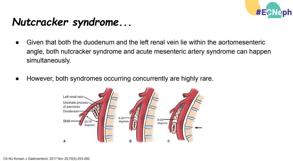 Nutcracker Syndrome Causes