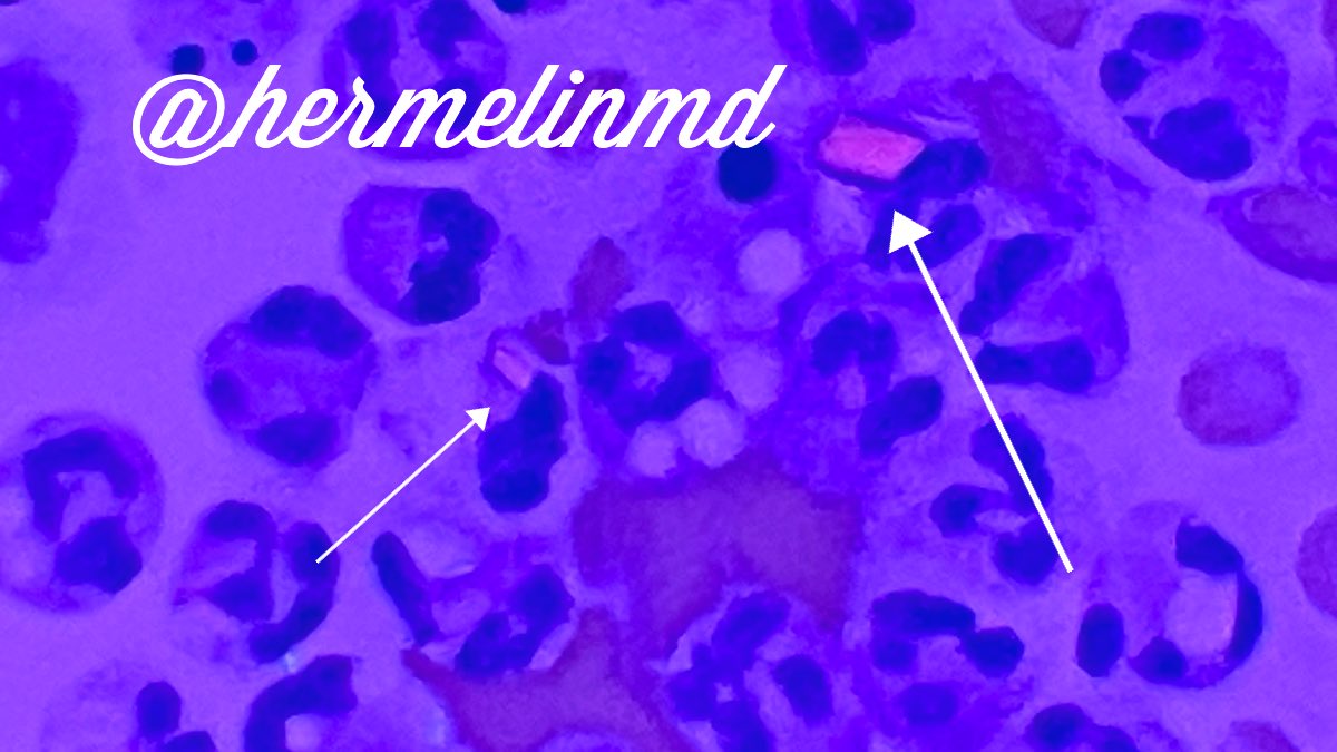 Pyrophosphate Crystals