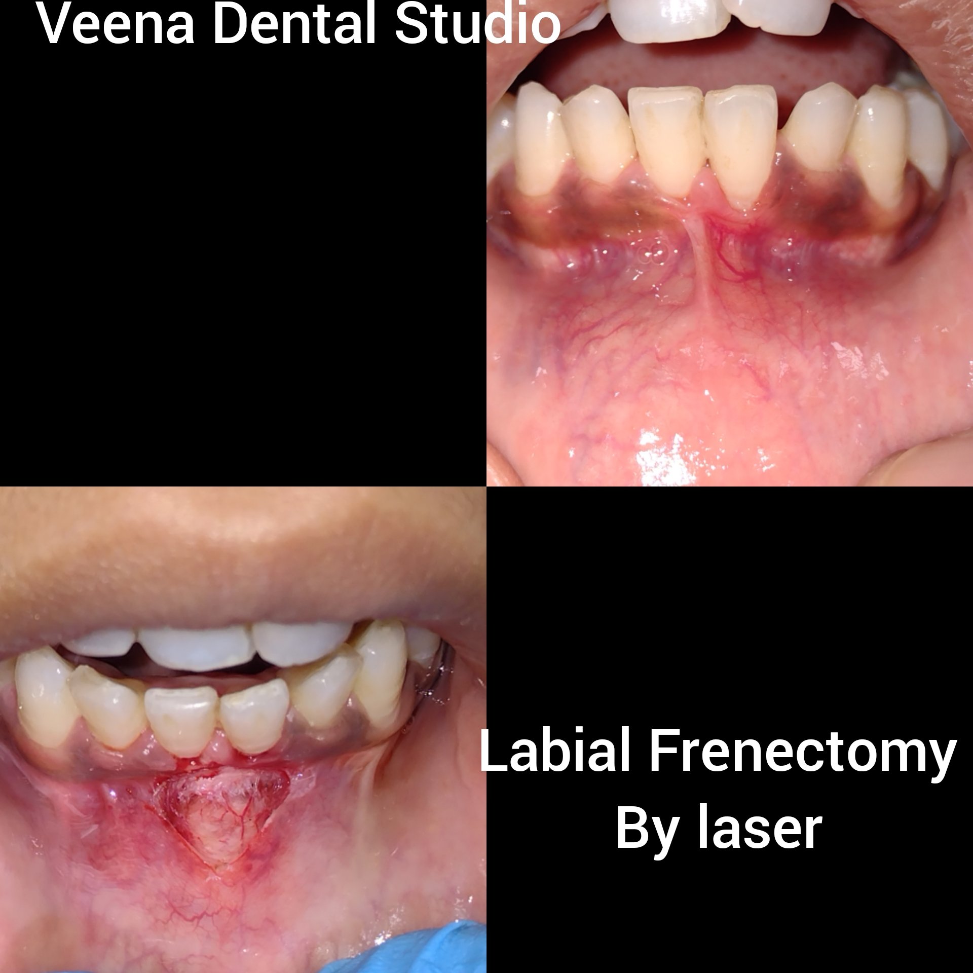 Labial Frenectomy