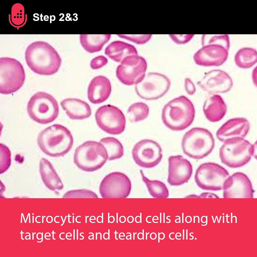 Target Cells Thalassemia