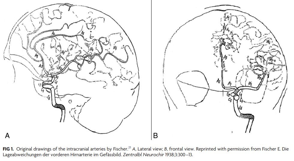 Where does the middle cerebral artery M1 segment become the M2 segment ...