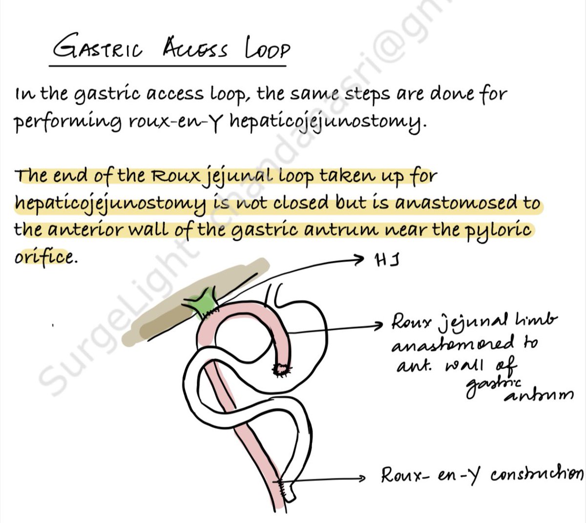 Roux En Y Hepaticojejunostomy