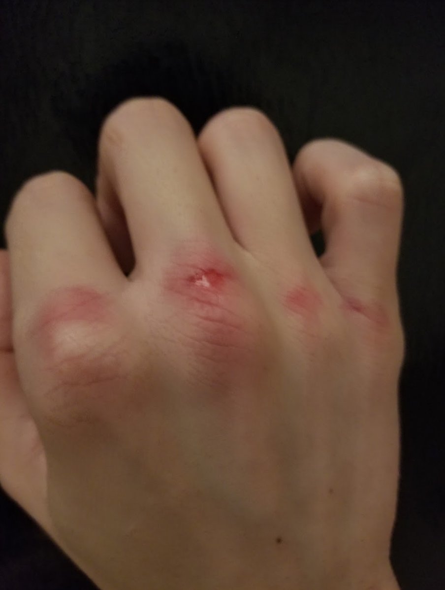 Bruised Knuckles From Punching A Wall