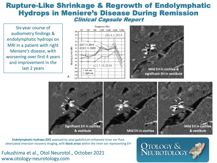 Endolymphatic Hydrops Mri