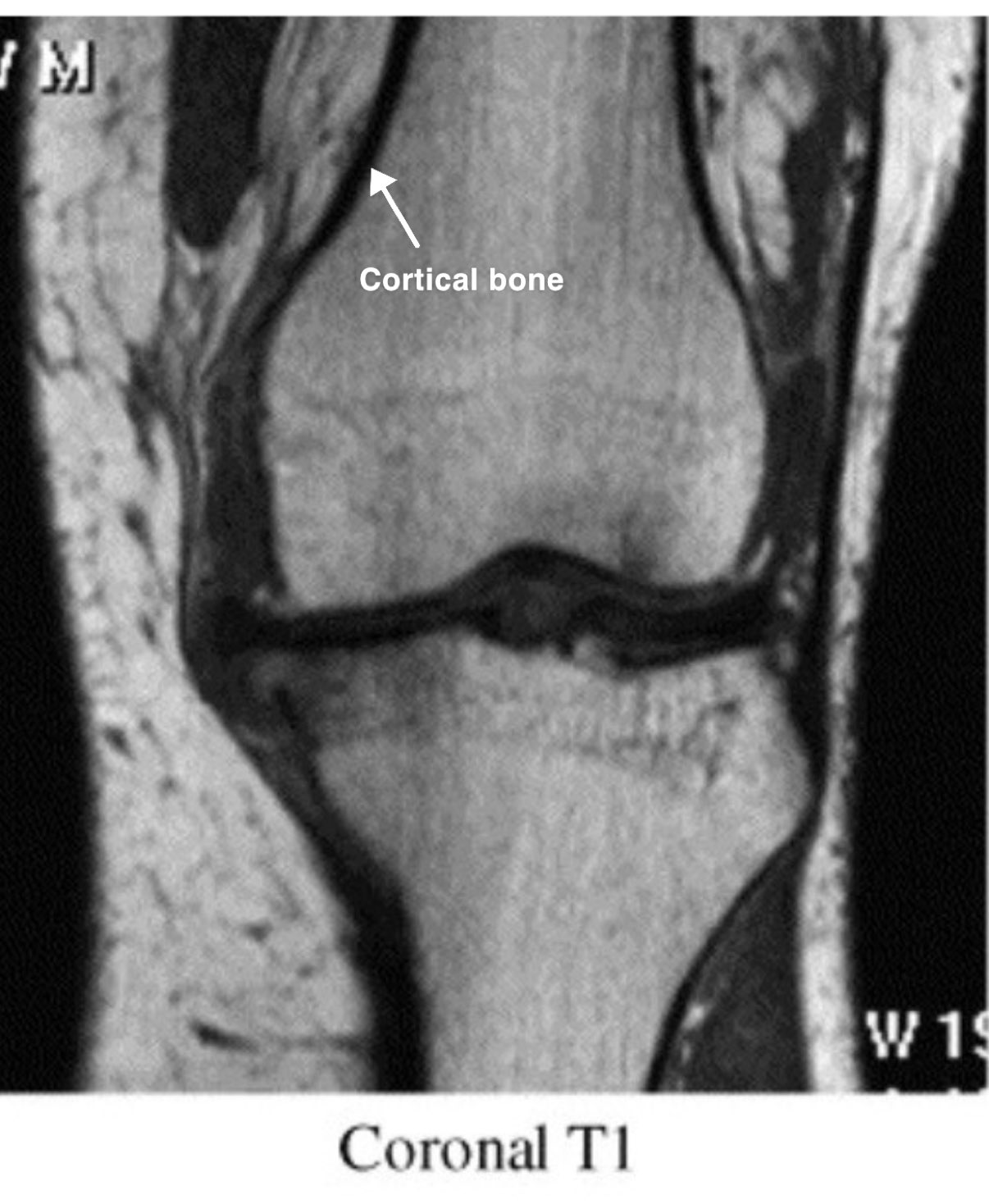 Cortical Bone Mri