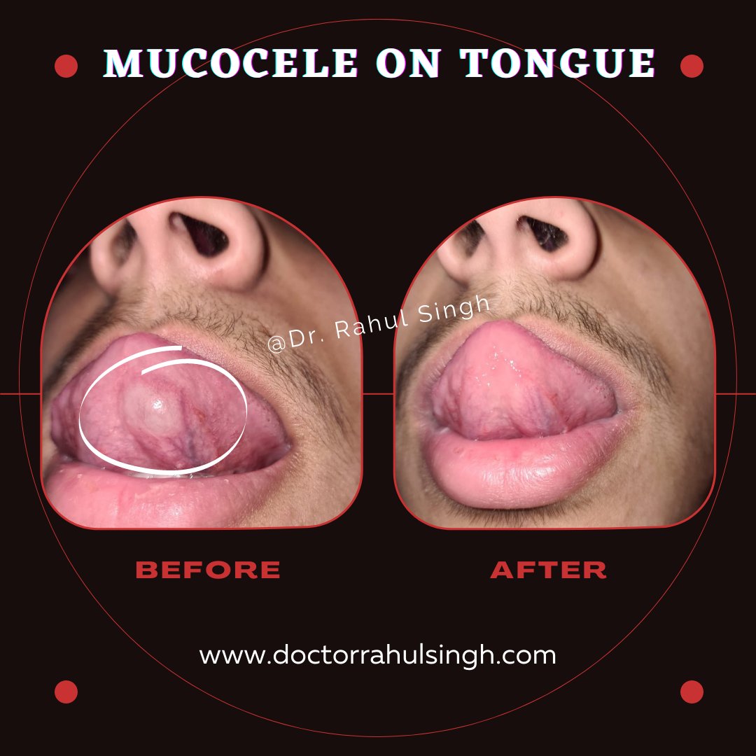 Mucocele Under Tongue