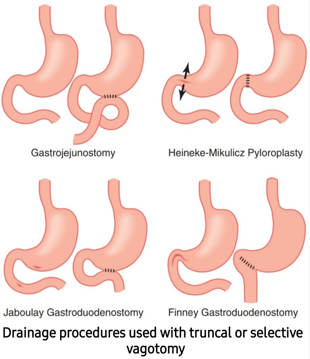 Vagotomy And Pyloroplasty