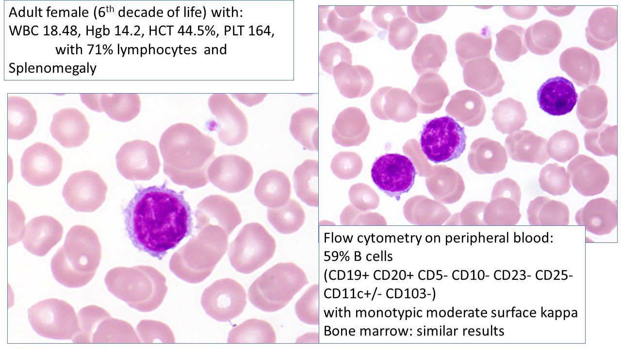 Leukemia Cells Differential