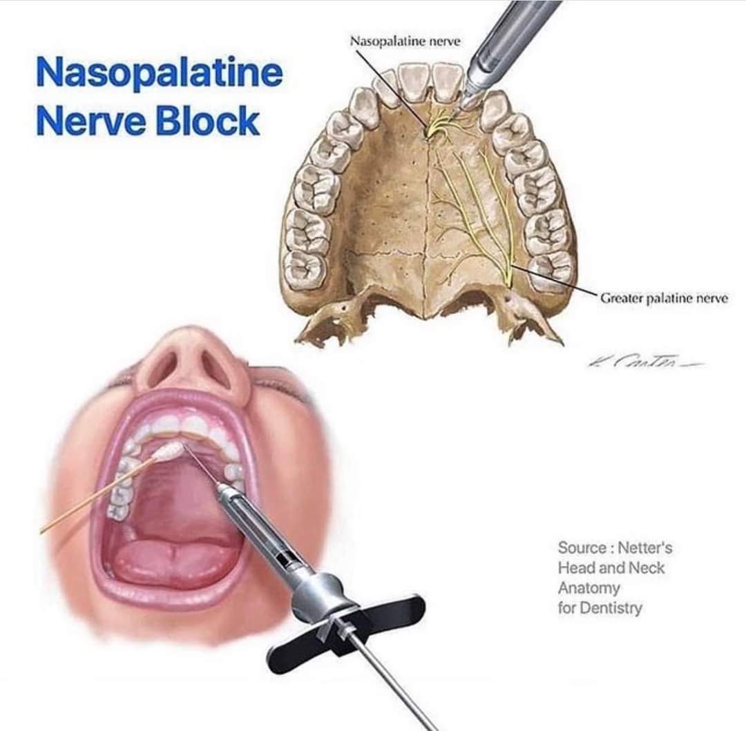 Nasopalatine Nerve Incisive