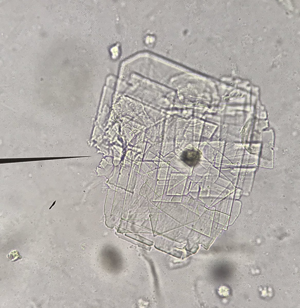 Cholesterol Crystals In Urine Sediment