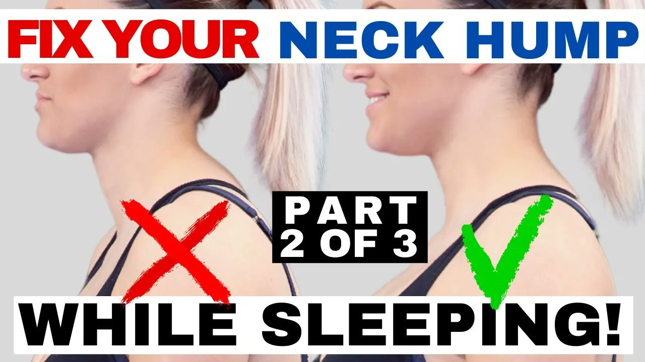 Forward Head Posture Neck Hump
