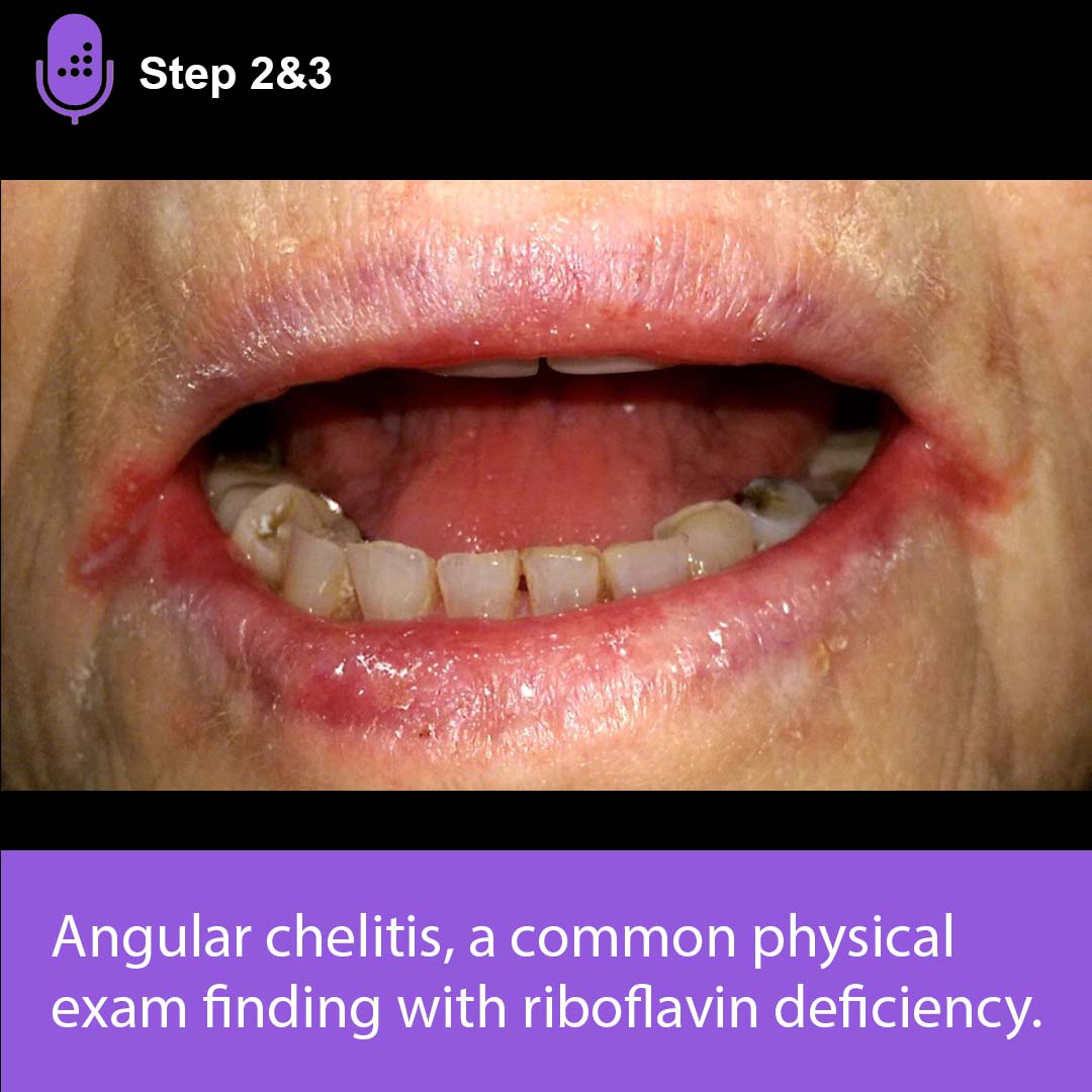 Vitamin B2 Deficiency