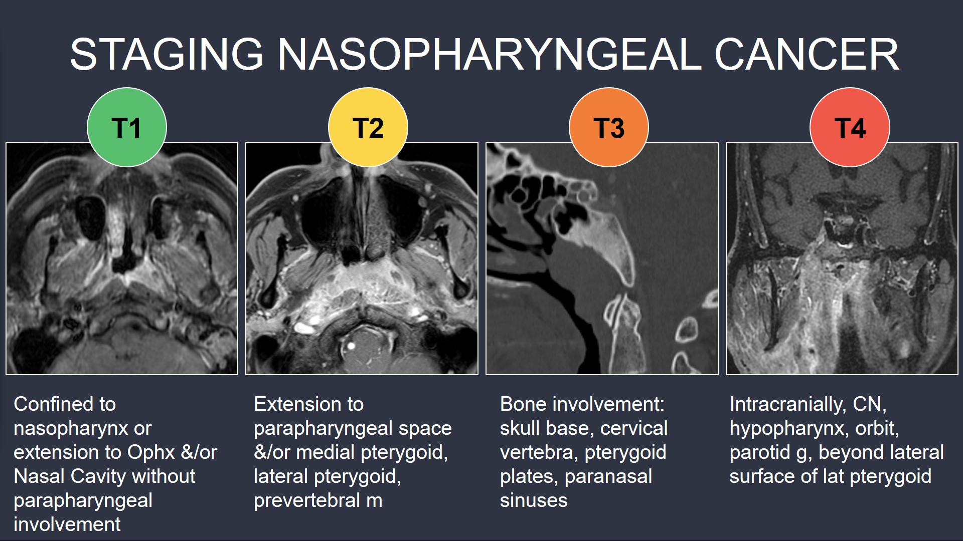 Nasopharyngeal Carcinoma Mri