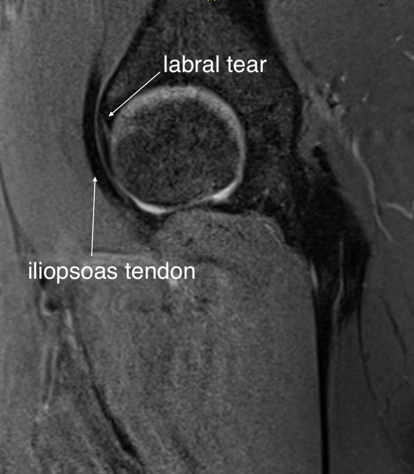 Hip Labrum Tear Mri