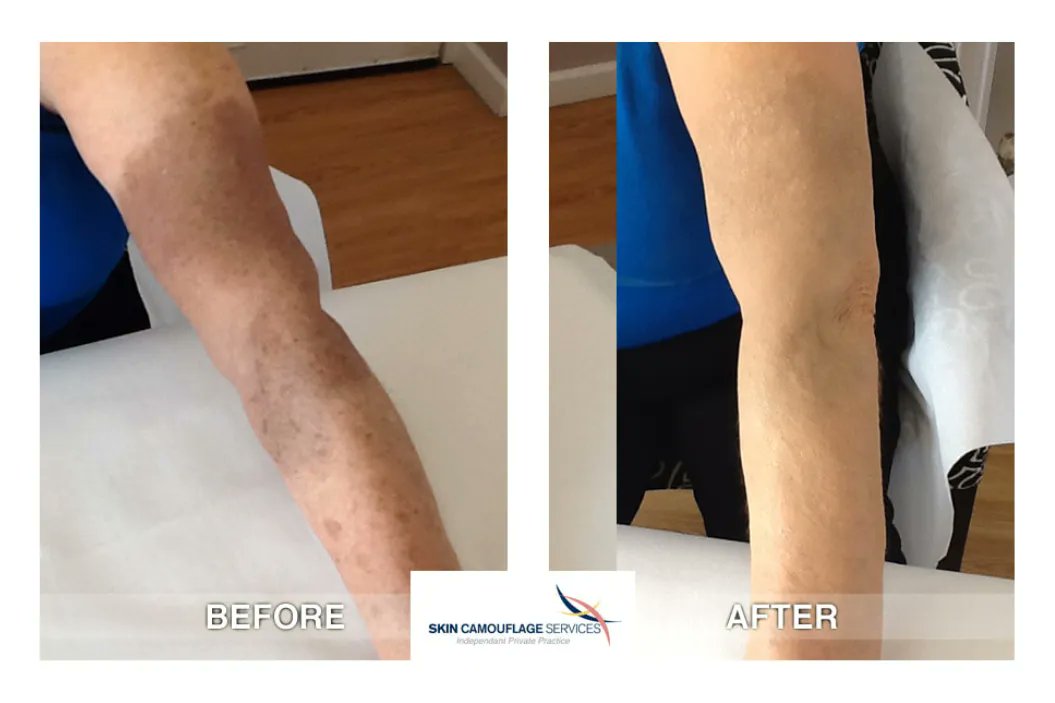 Hyperpigmentation Arms