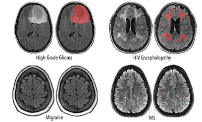 Healthy Vs Unhealthy Brain