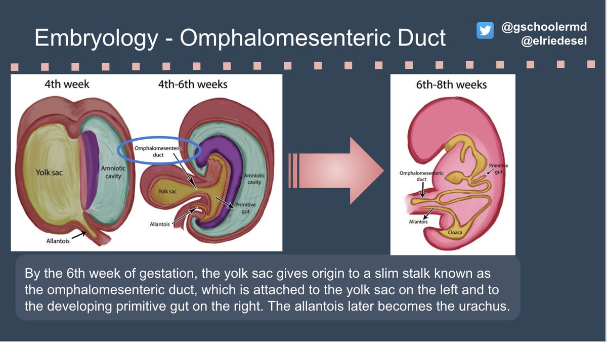 Omphalomesenteric Cyst