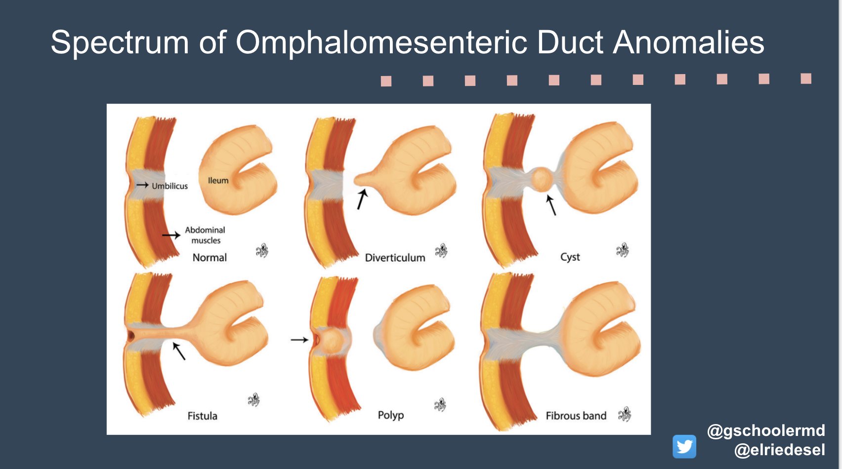 Omphalomesenteric Duct