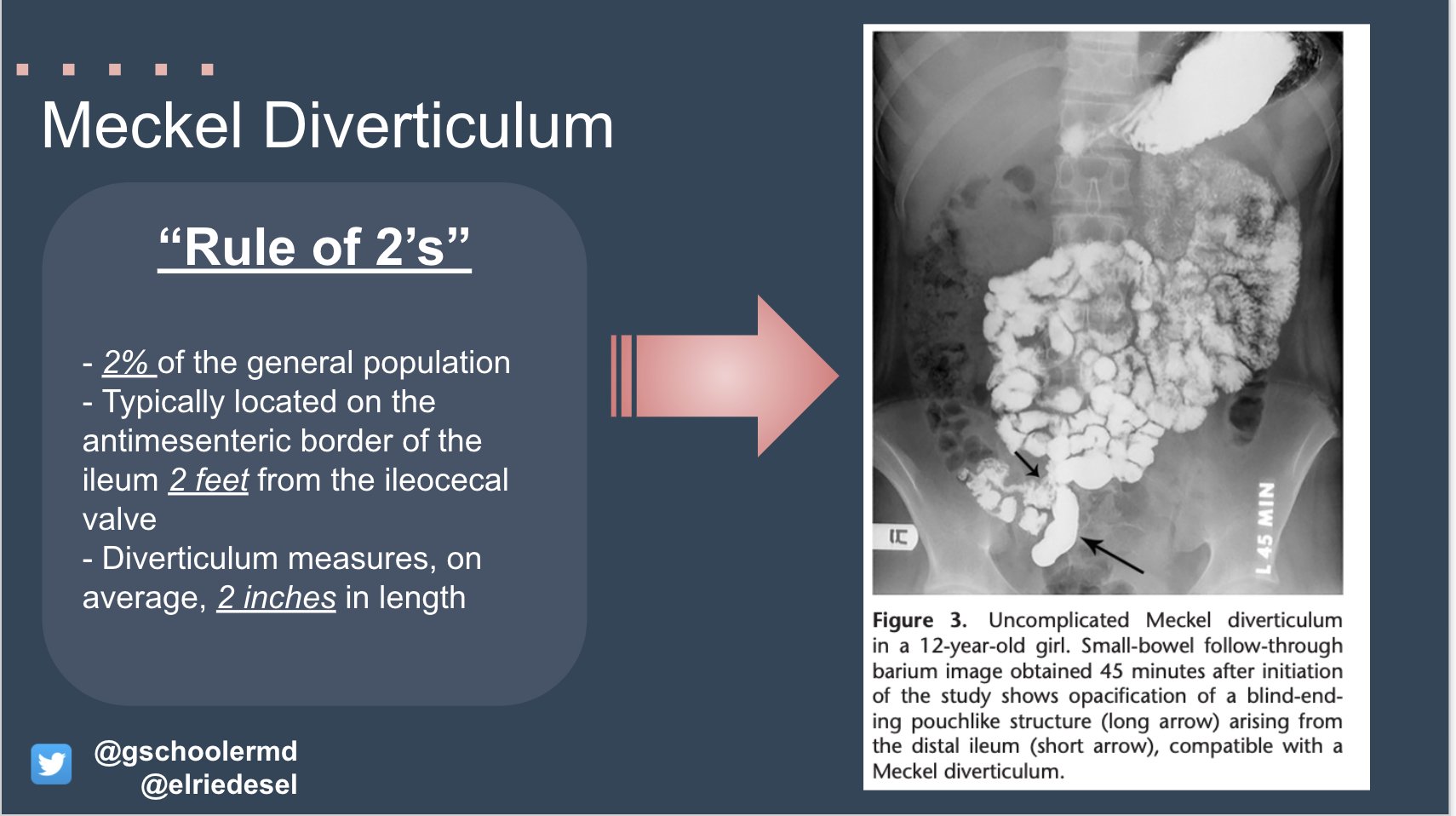 Meckels Diverticulum Rule Of 2