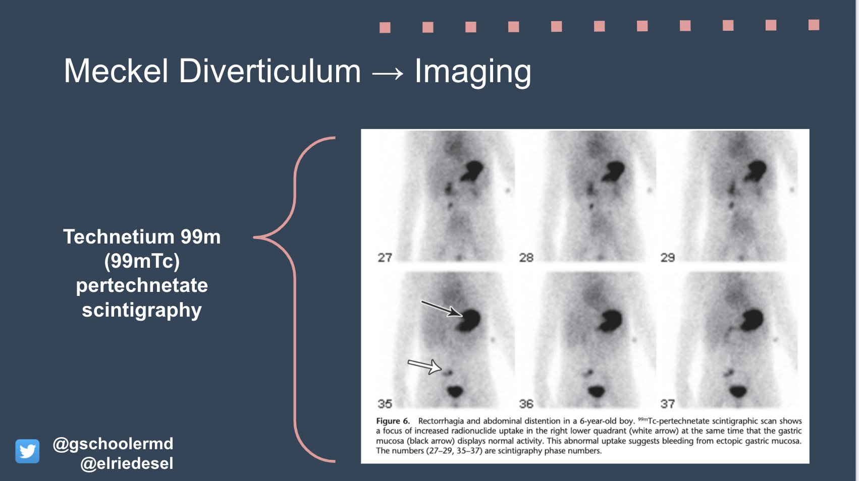 Meckel Diverticulum Technetium Scan