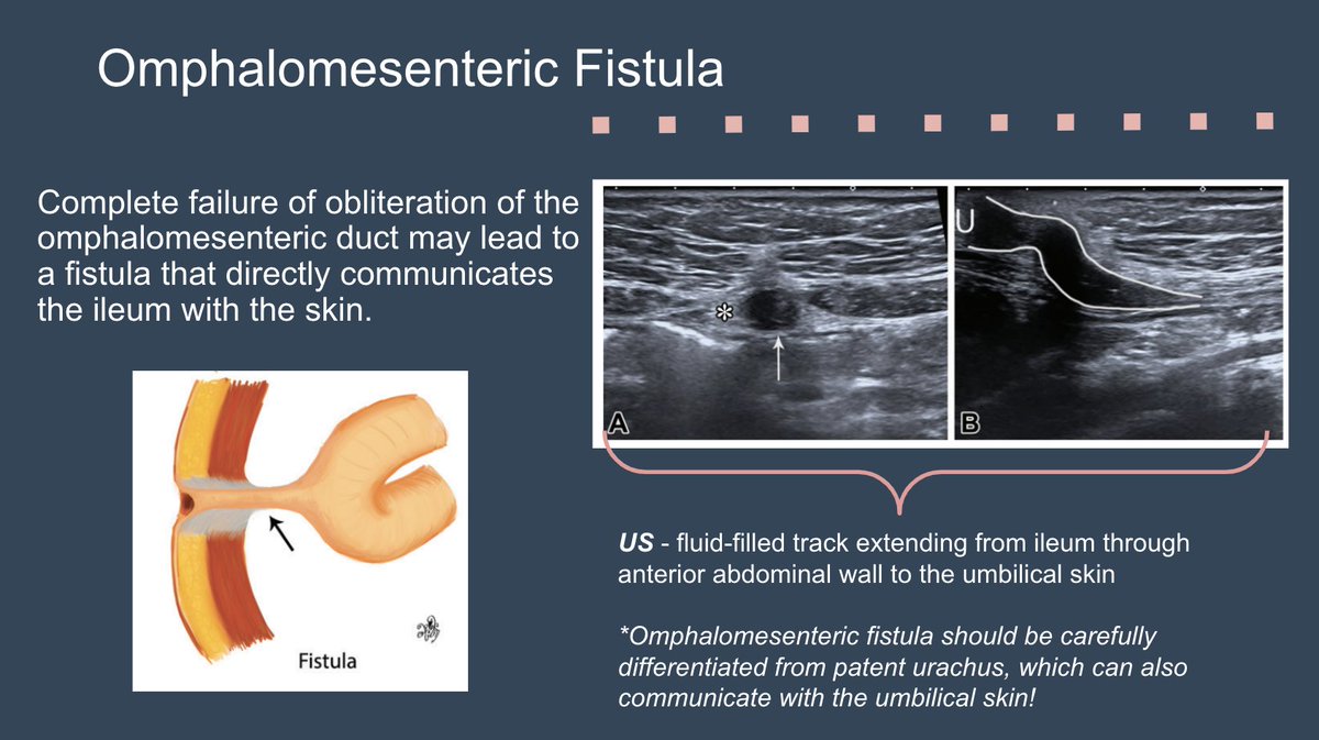 Omphalomesenteric Duct