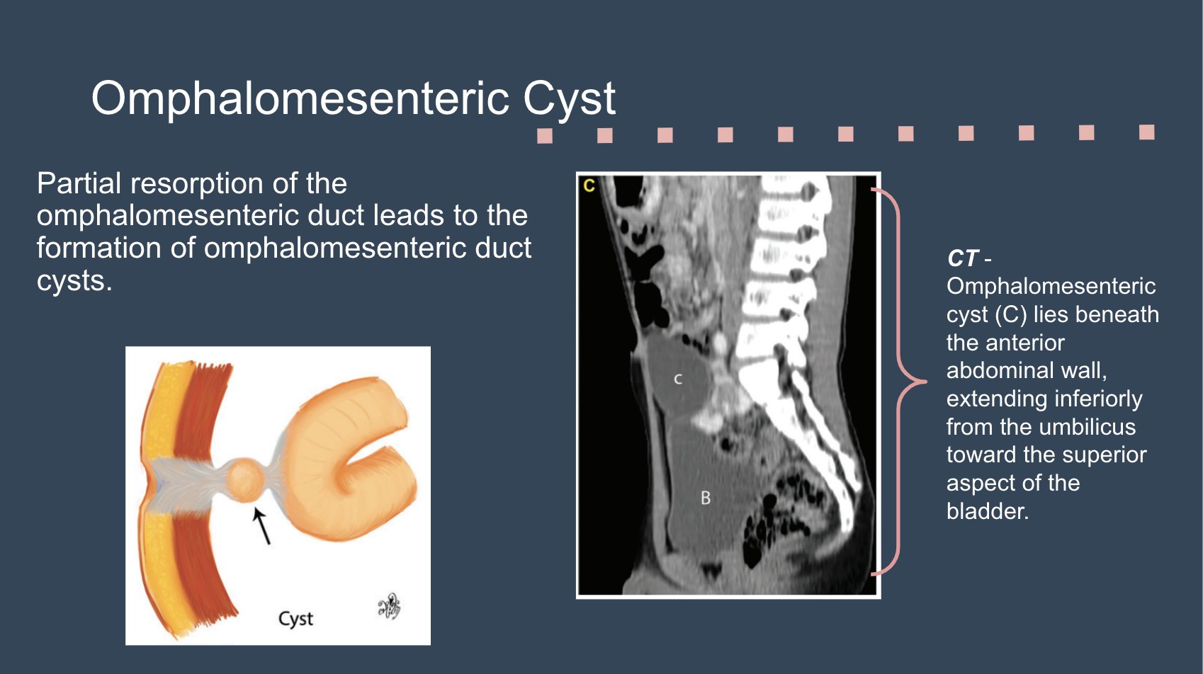 Omphalomesenteric Cyst